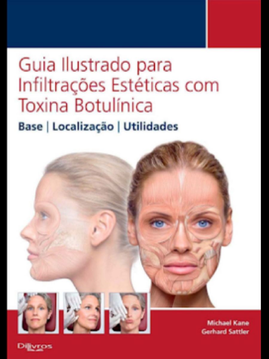Guia Ilustrado para Infiltrações Estéticas com Toxina Botulínica ...